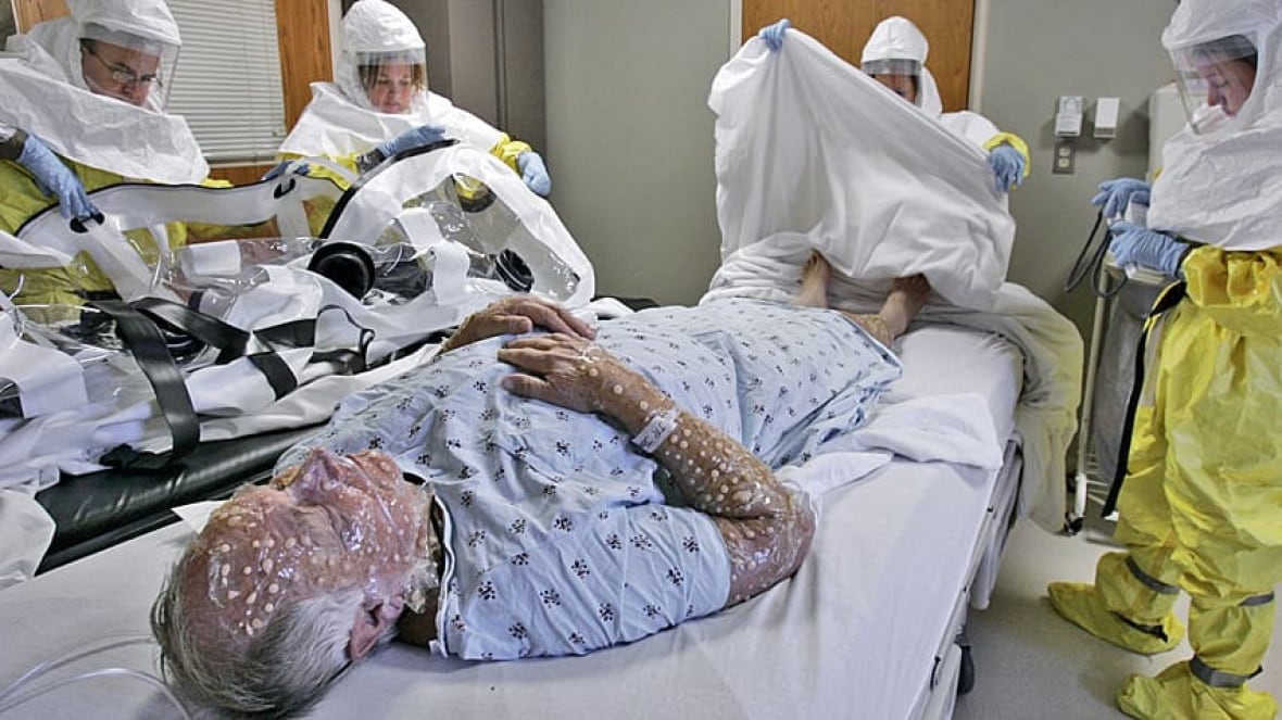 Safer Smallpox Vaccine In The Works At The University Of Alberta CBC News