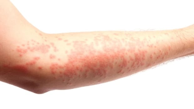 5 Strange Allergies From Sex To Sunlight Cbc News