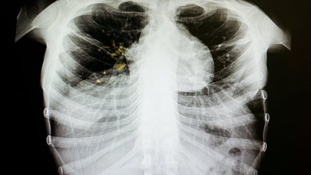 5 Workers At Michigan Wildlife Lab Get Latent Form Of TB CBC News 5-workers-at-michigan-wildlife-lab-get-latent-form-of-tb-cbc-news