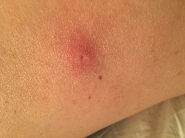 Tick Bite Pictures Symptoms What Does A Tick Bite Look Like Lupon gov ph